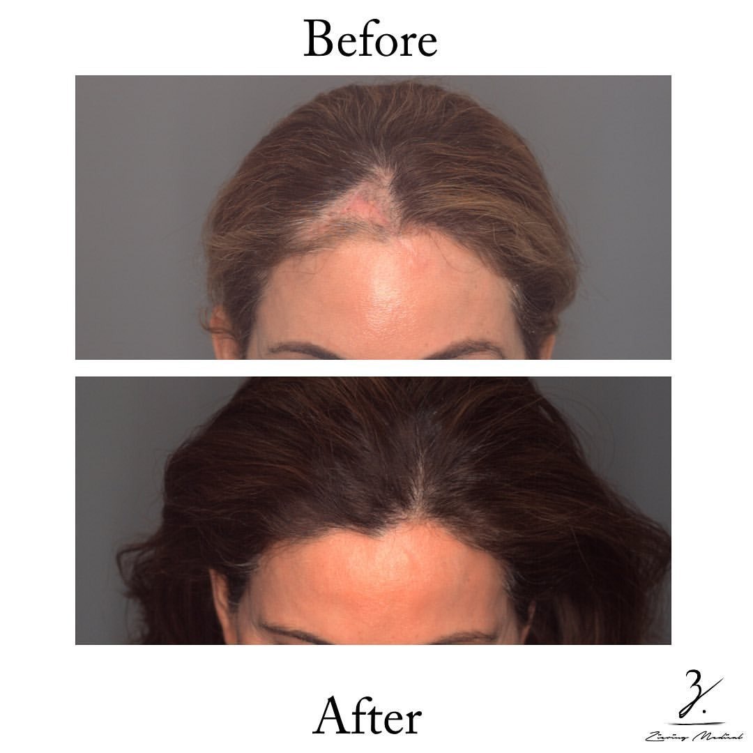 Hair Transplant Surgery: Types, What to Expect, Costs, Photos and More ...